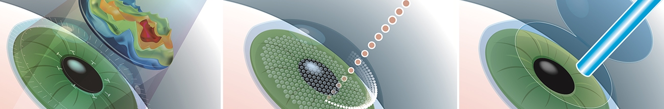 What Types Of Vision Problems Does Refractive Surgery Correct?